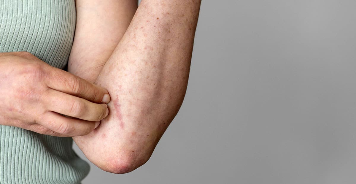 Dermatite atópica e alergias alimentares – Faculdade de Saúde Avançada